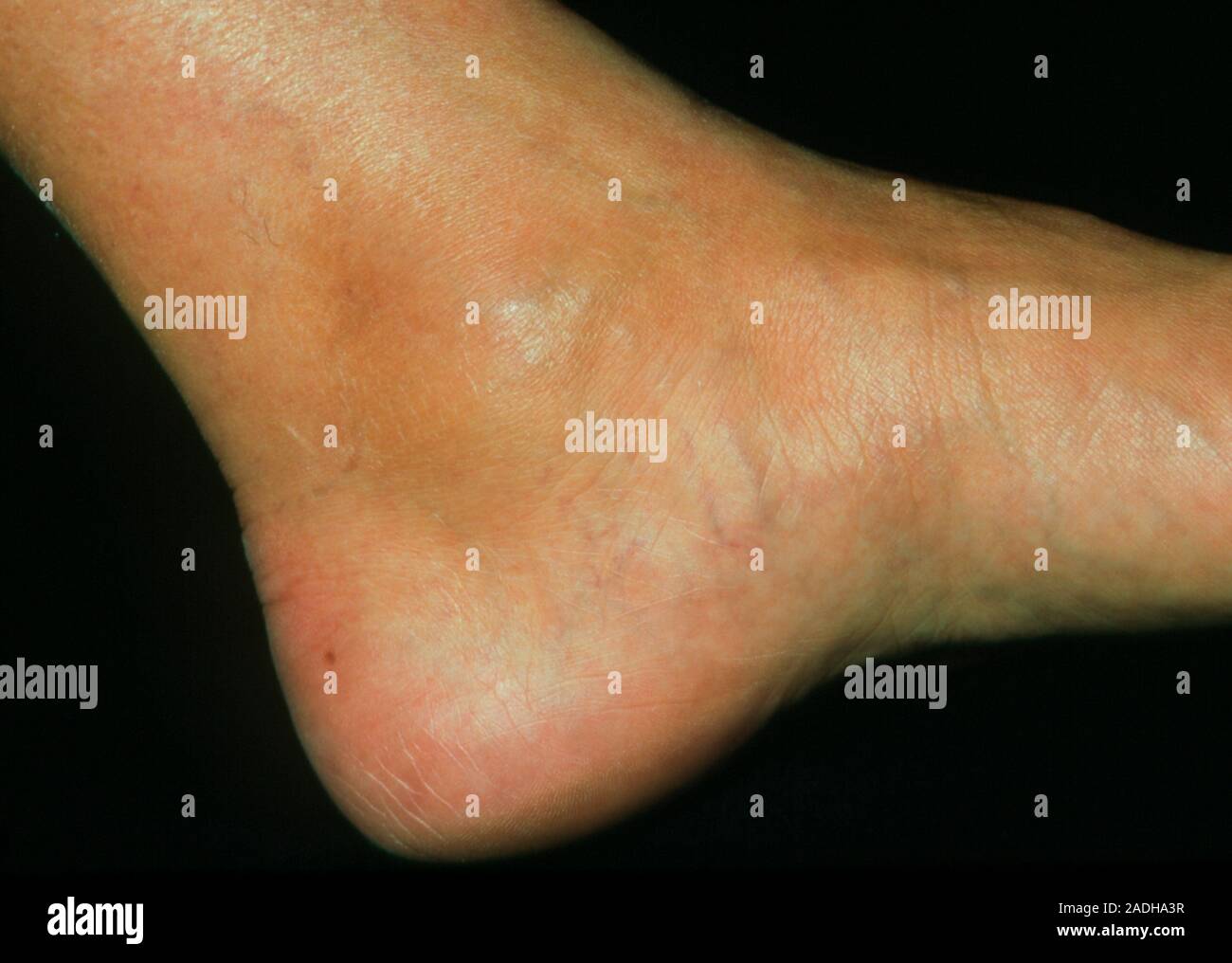 Crohn's disease. Close up of the swollen ankle joint of a 34 year-old ...