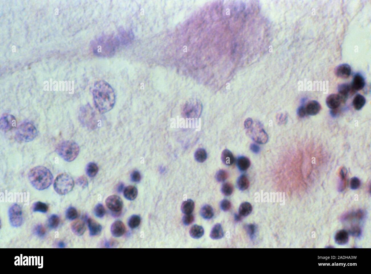 Creutzfeldt-Jakob disease. Light micrograph of a section through human ...