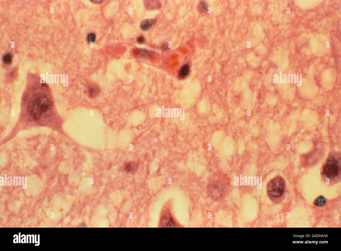 Creutzfeldt-Jakob disease. Light micrograph of a section through human ...