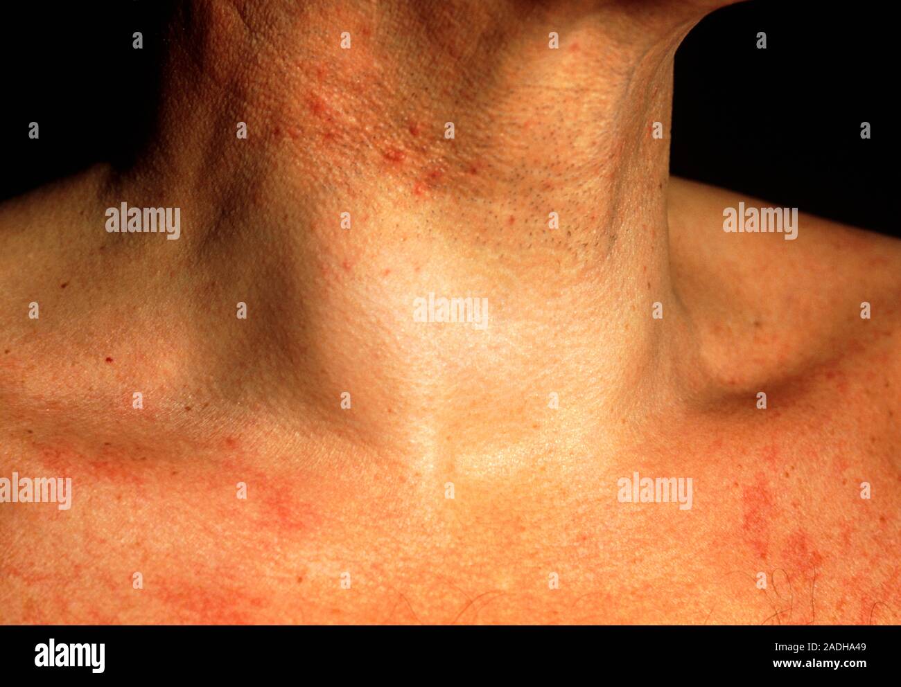 Thyroid cyst. View of a swelling on the throat of a 56 year old man ...