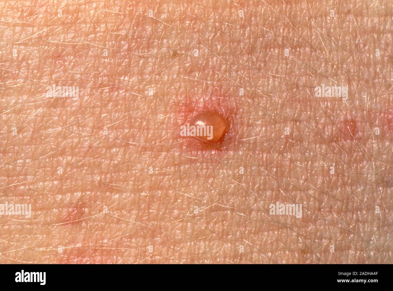 Chickenpox. Close-up of a vesicle (lesion) on the skin of a patient ...