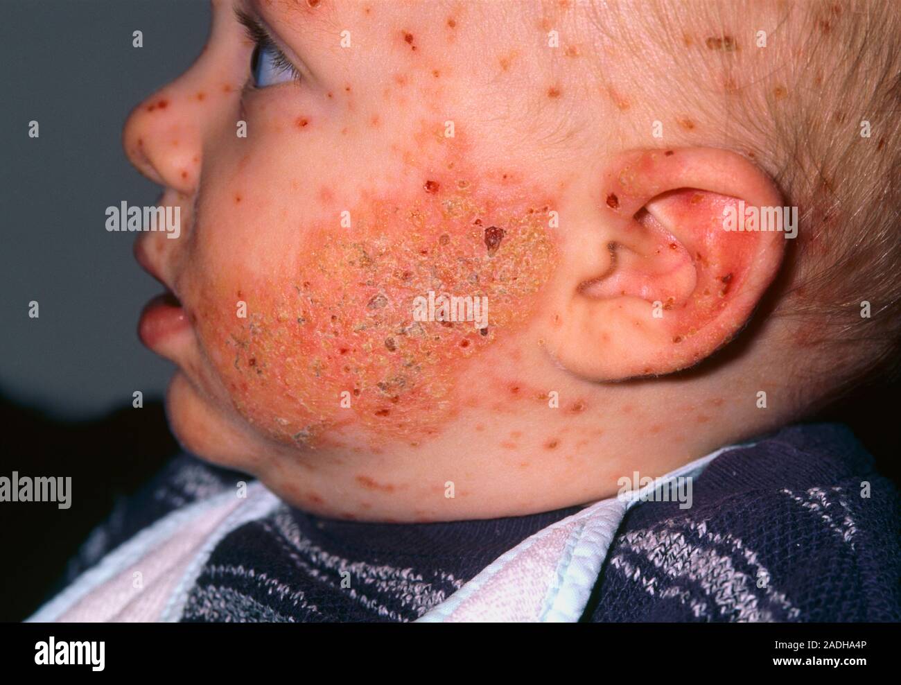 Chickenpox and eczema. Chickenpox and atopic eczema on the face of a ...
