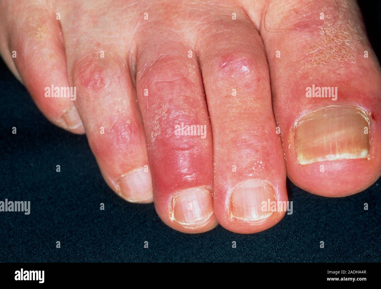 Chilblains. Chilblains on the toes of a 56-year- old female patient on ...