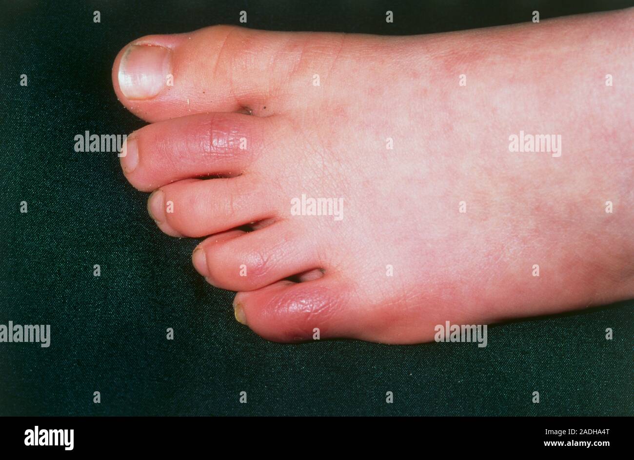 Chilblains. Chilblains on the toes of a 6-year- old girl. Chilblains ...