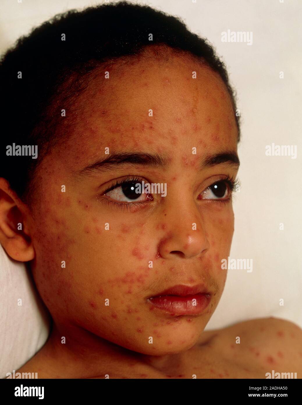 Chickenpox. Chickenpox on the face of a young boy. Chickenpox (or ...