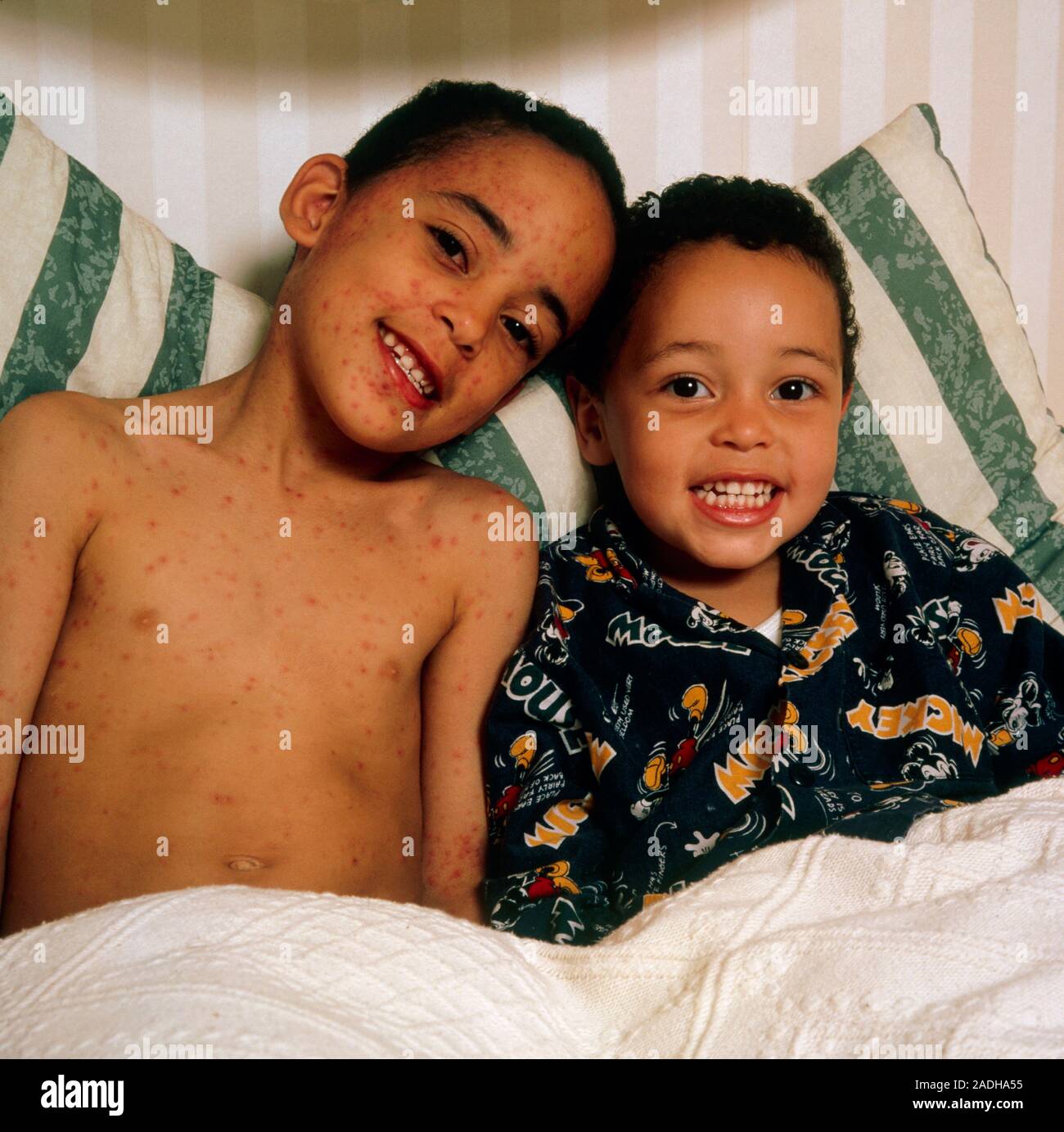Chickenpox. Young boy with chickenpox sits in bed with his unaffected ...