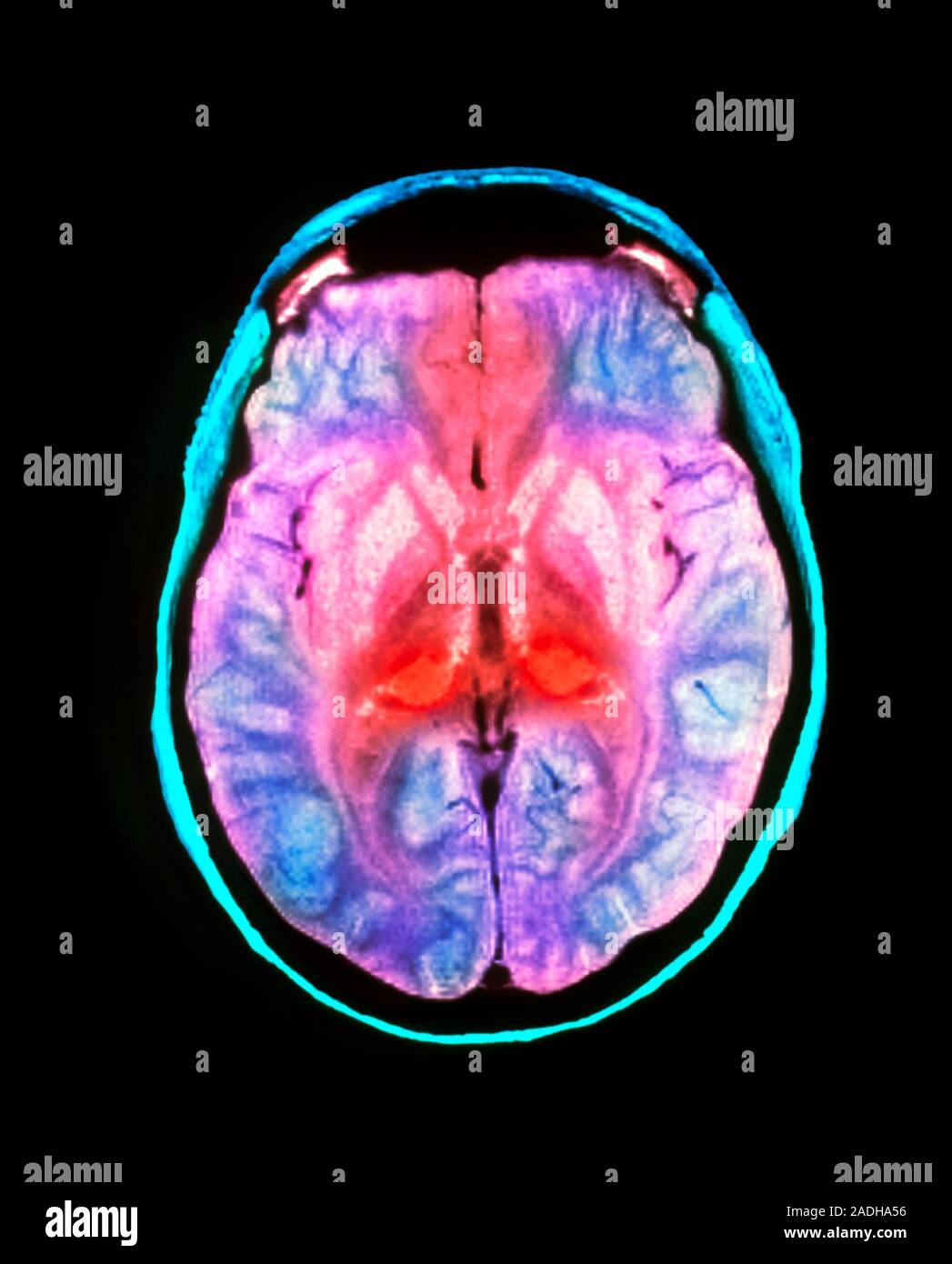 Creutzfeldt-Jakob disease. Coloured Magnetic Reso- nance Imaging (MRI ...