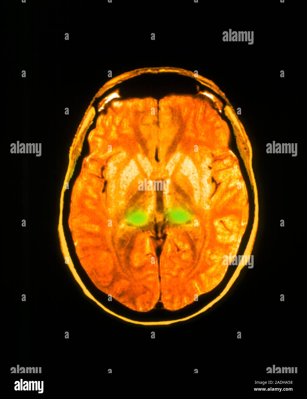 Creutzfeldt-Jakob disease. Coloured Magnetic Reso- nance Imaging (MRI ...