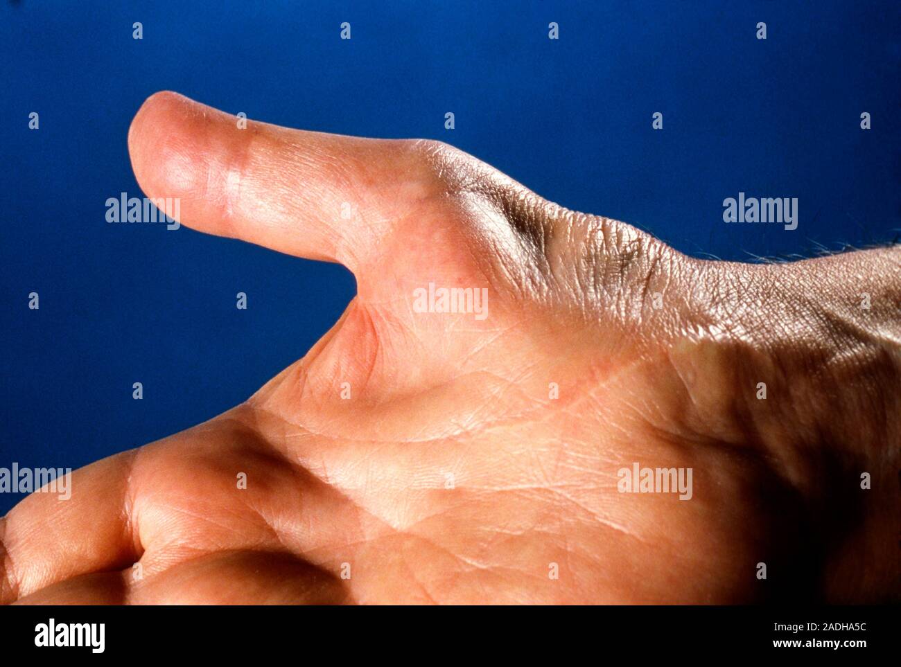 Carpal tunnel syndrome. Wasting of the thenar muscles in a hand ...