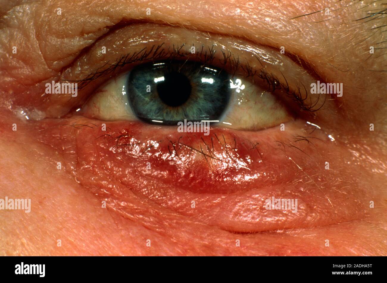 Stye. Close-up of a patient's eye, showing a stye (hordeolum) on the ...