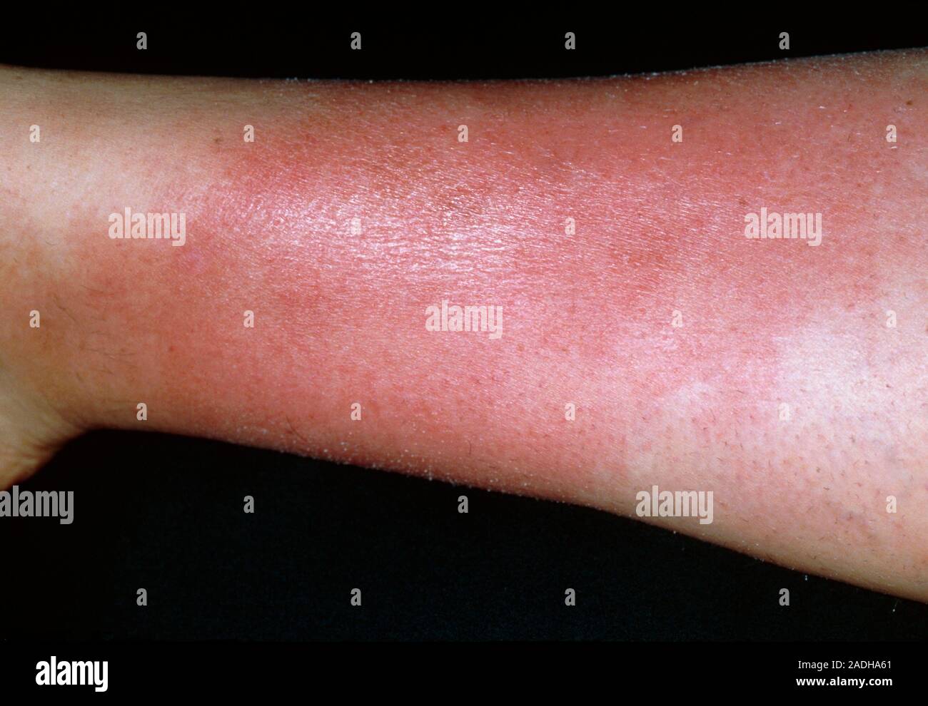 Cellulitis. Close-up of a red and inflamed area on a 36 year old woman ...