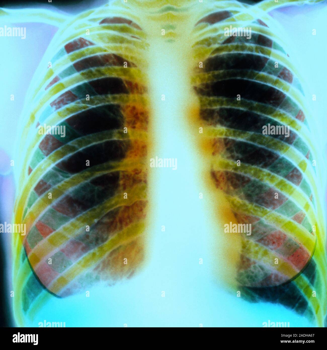 Cystic fibrosis. Coloured chest X-ray of the lungs of a patient with ...