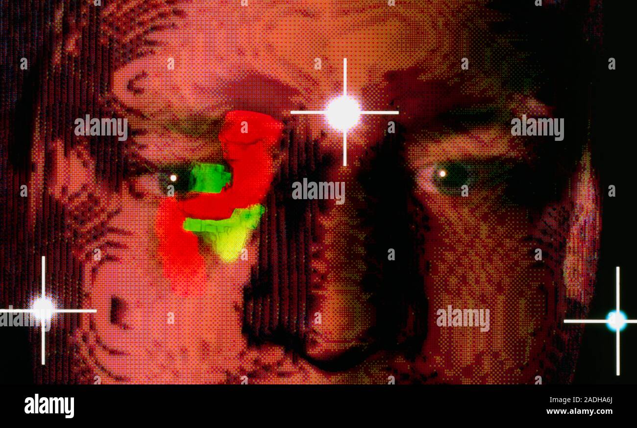 Brain cyst. Coloured three-dimensional magnetic resonance imaging (MRI ...