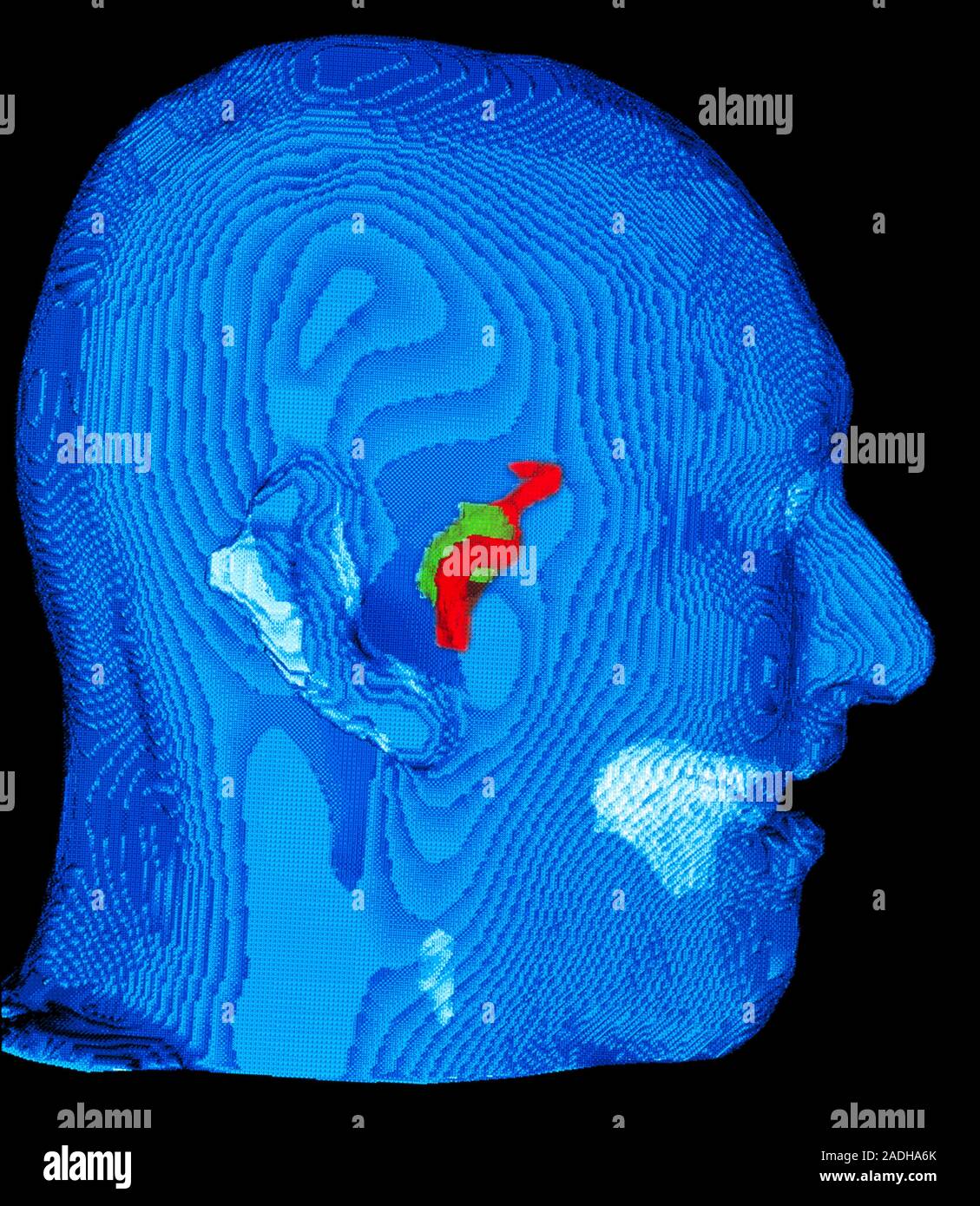 Brain cyst. Coloured three-dimensional magnetic resonance imaging (MRI ...