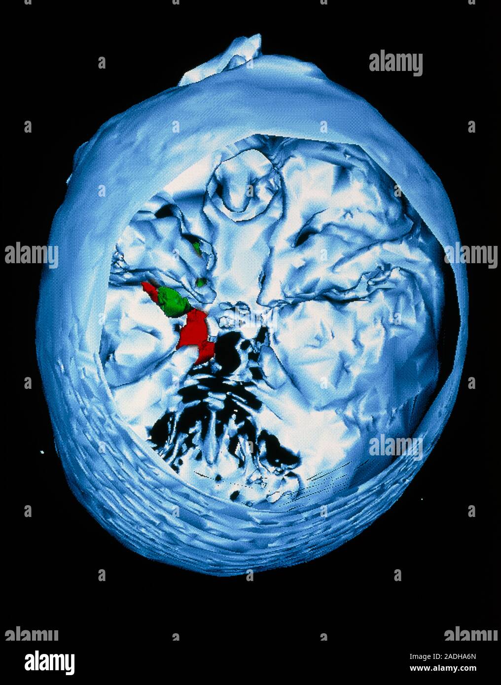 Brain cyst. Coloured three-dimensional magnetic resonance imaging (MRI ...