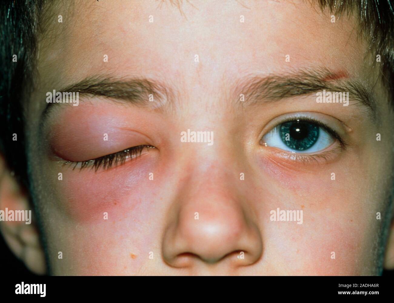 Cellulitis. View of the face of an eight year old boy showing one eye ...