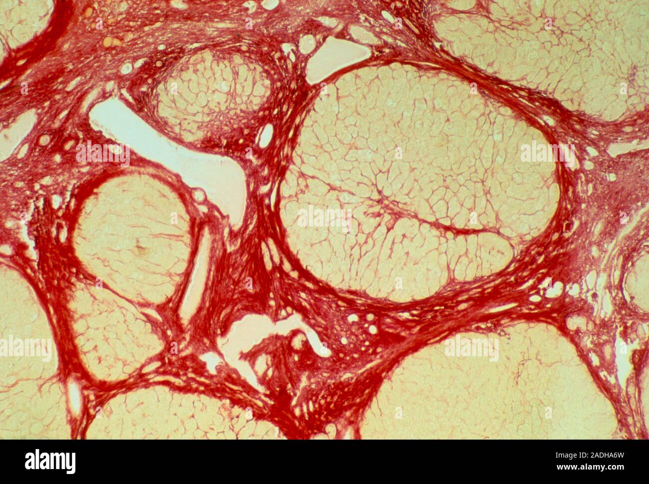 Liver cirrhosis. Light micrograph of a section through liver tissue ...