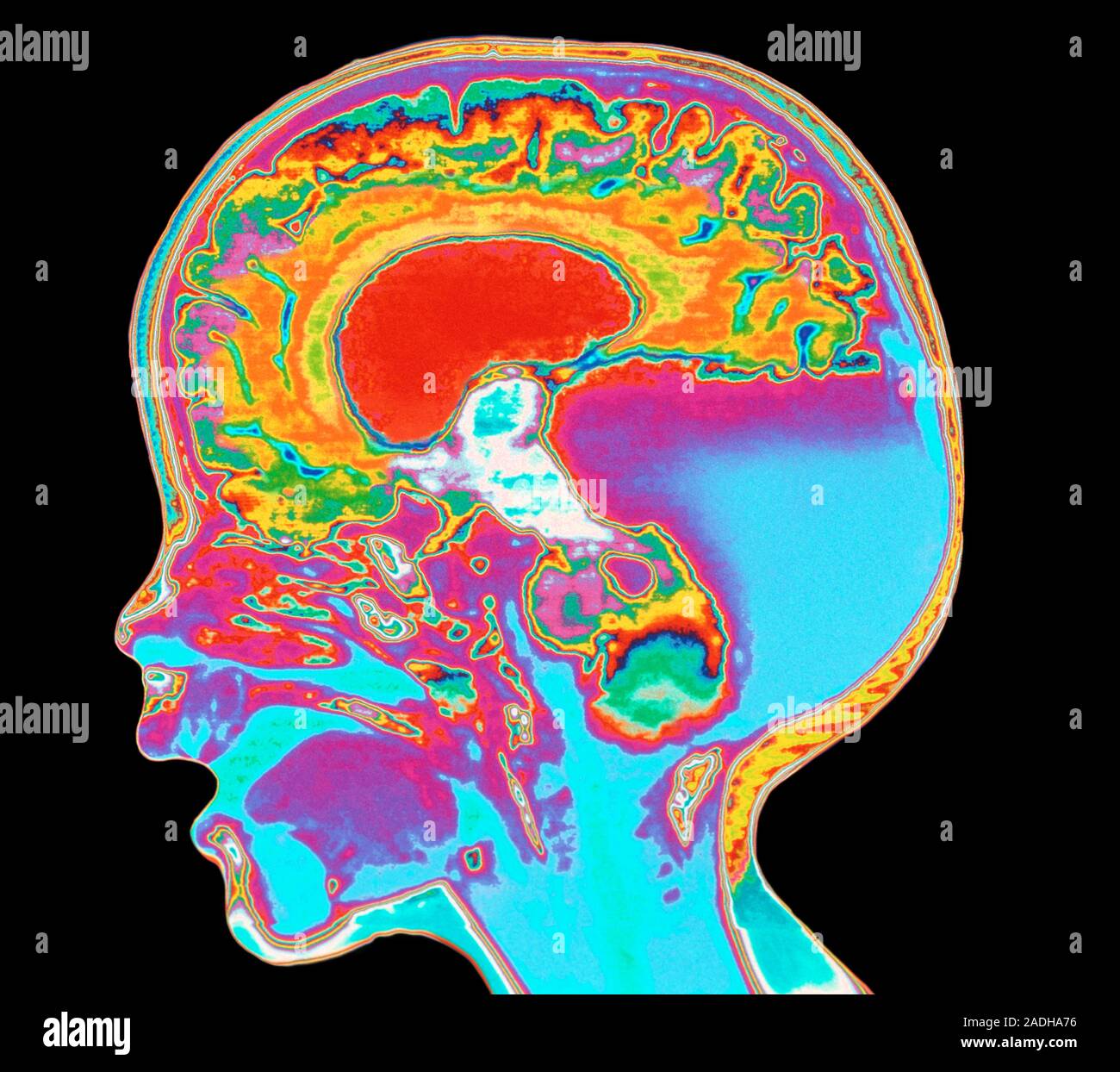 Brain cyst. Coloured magnetic resonance imaging (MRI) scan of a section ...