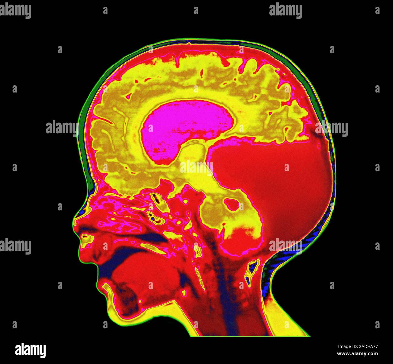 Brain cyst. Coloured magnetic resonance imaging (MRI) scan of a section ...