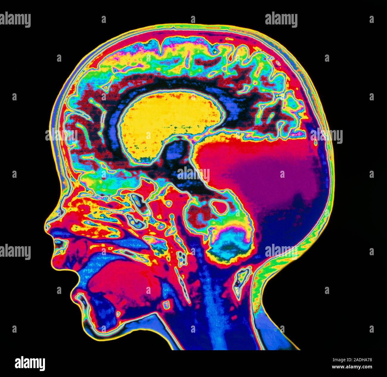 Brain cyst. Coloured magnetic resonance imaging (MRI) scan of a section ...