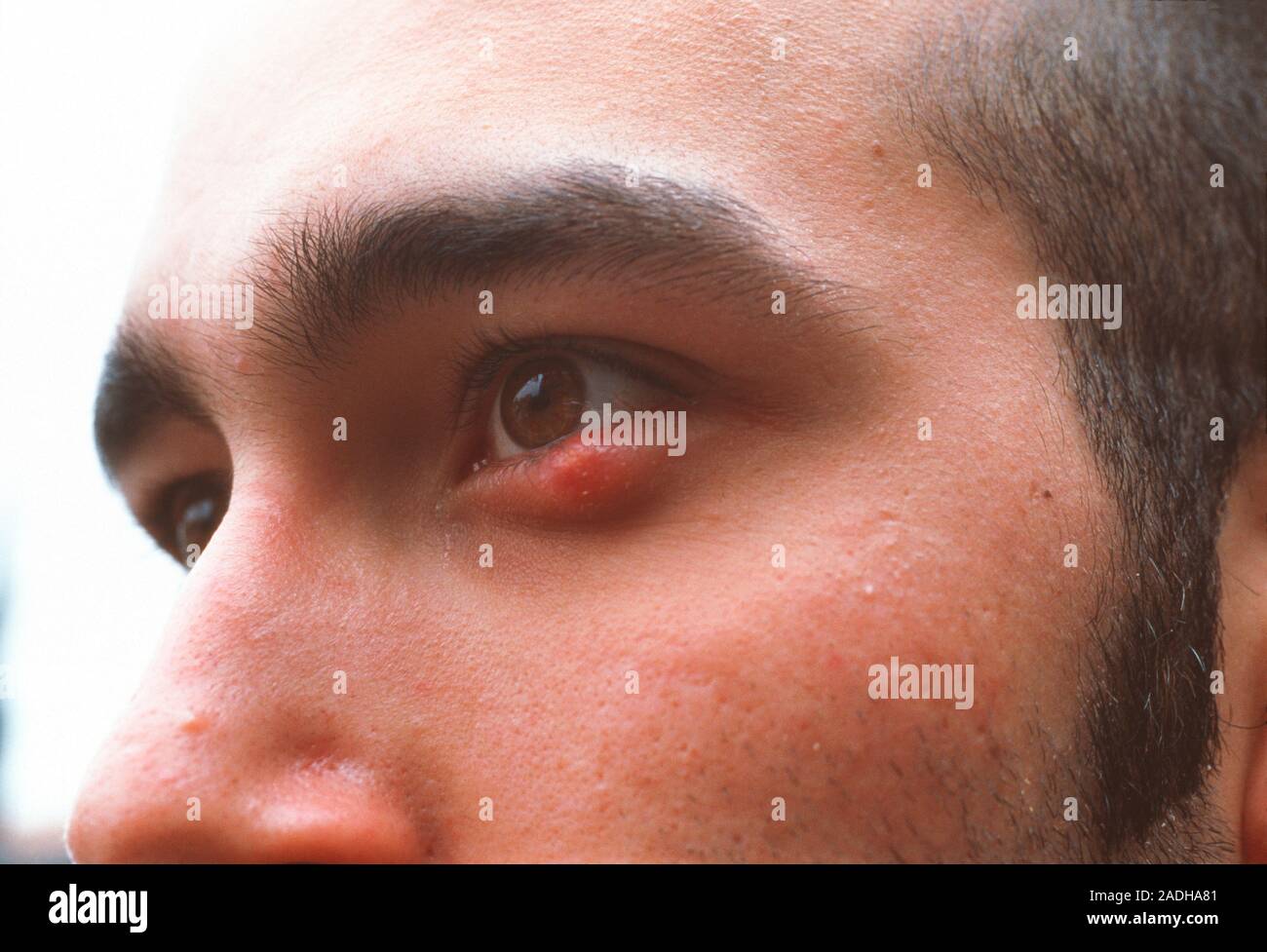 Stye (hordeolum) on the lower eyelid of a man. A stye is a pus-filled ...
