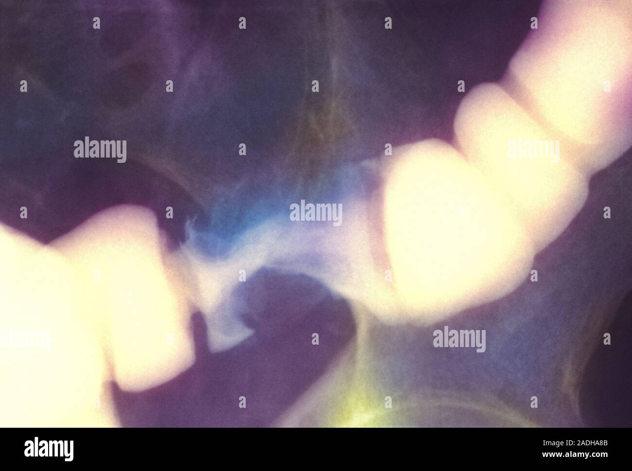 Colitis. Coloured barium X-ray showing a narrowed section (stricture ...