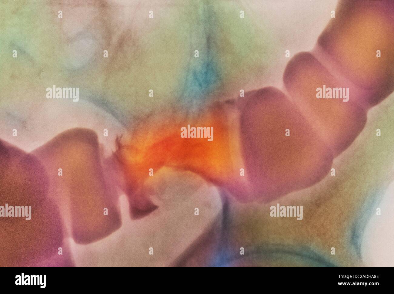 Colitis. Coloured barium X-ray showing a narrowed section (stricture ...