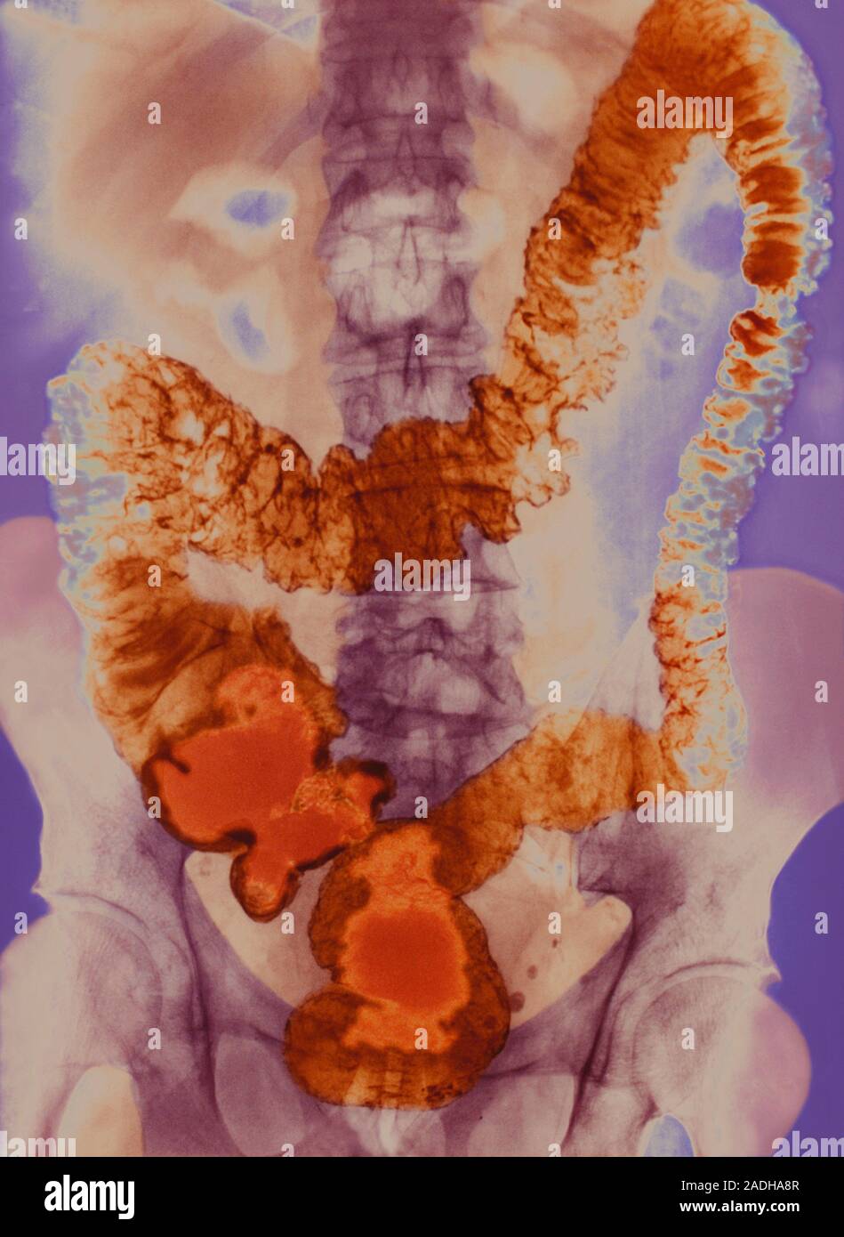 Ulcerative colitis. Coloured barium X-ray of the colon (orange) of a ...