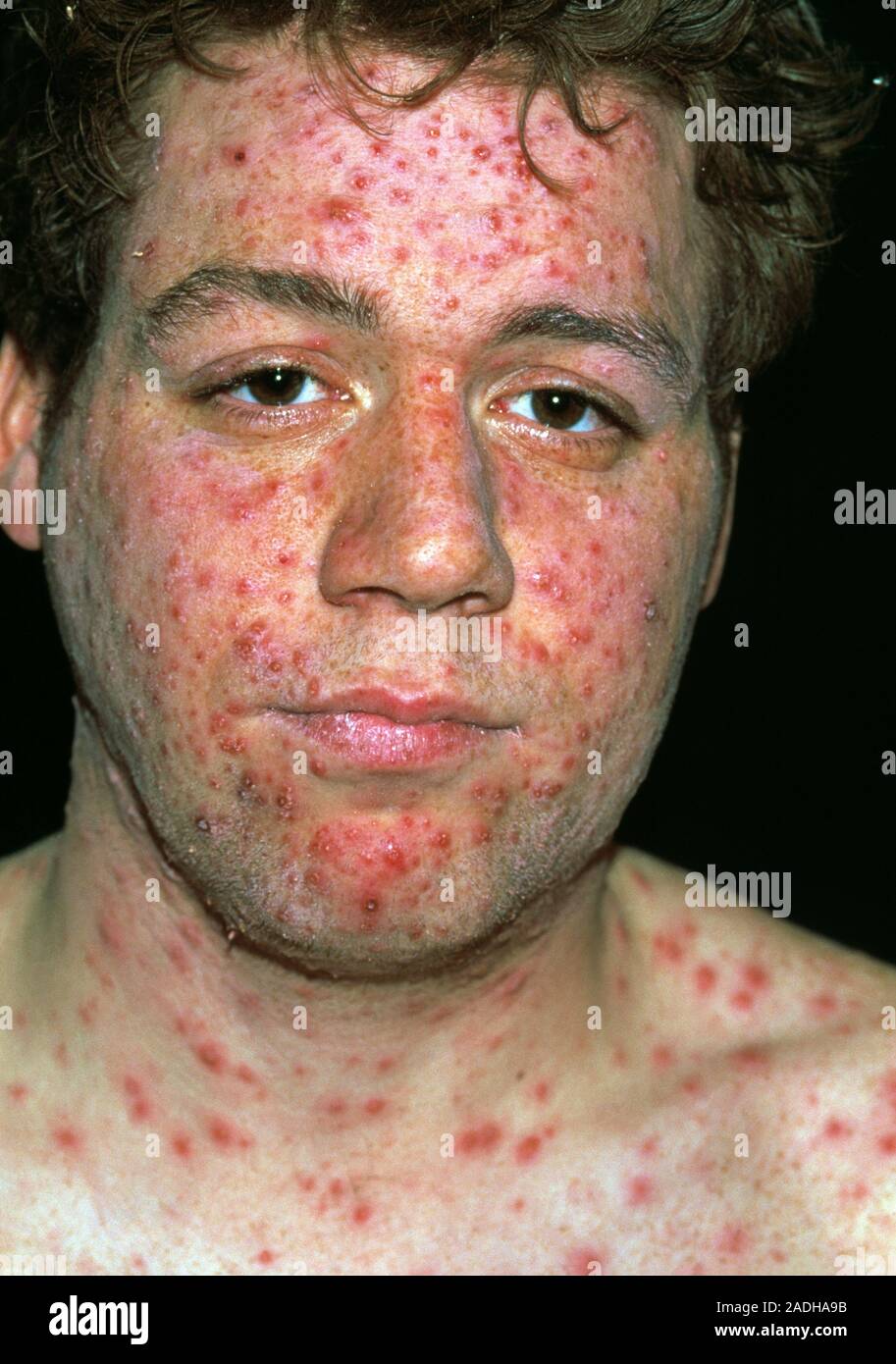 Chickenpox on face. Chickenpox blisters on the face and chest of a 22 ...