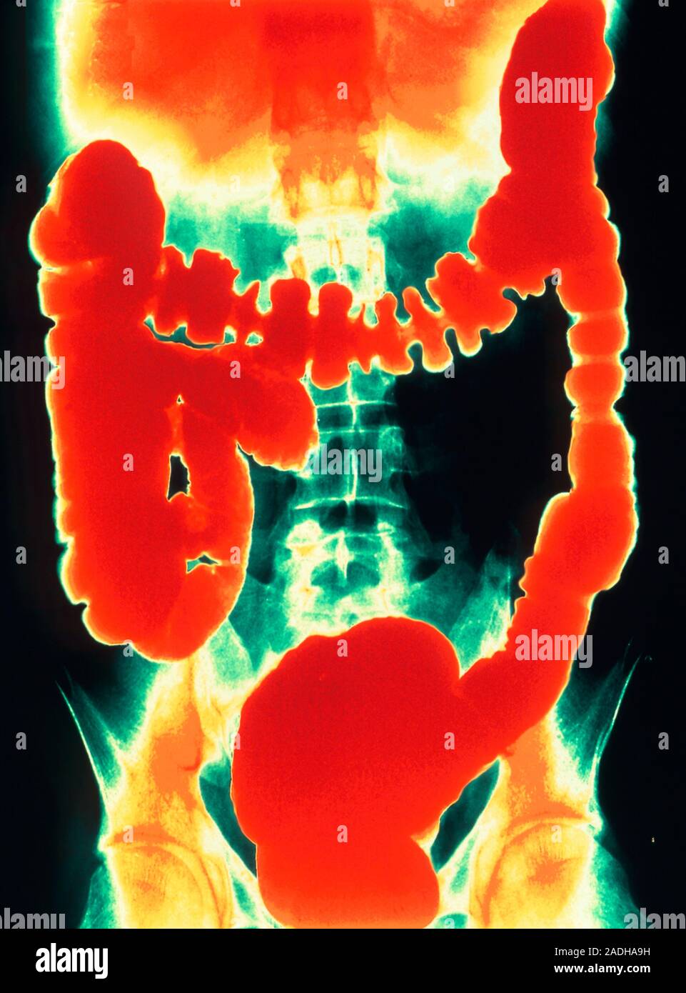 Crohns Disease Coloured Barium X Ray Of The Colon Large Intestine Red Of A Patient In The