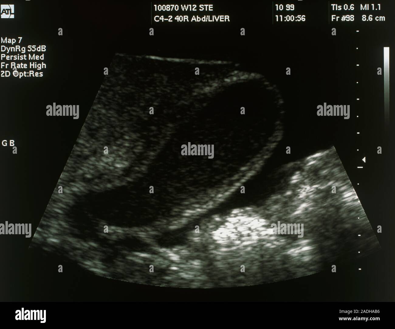 Inflamed gall bladder. Ultrasound scan of acute cholecystitis ...