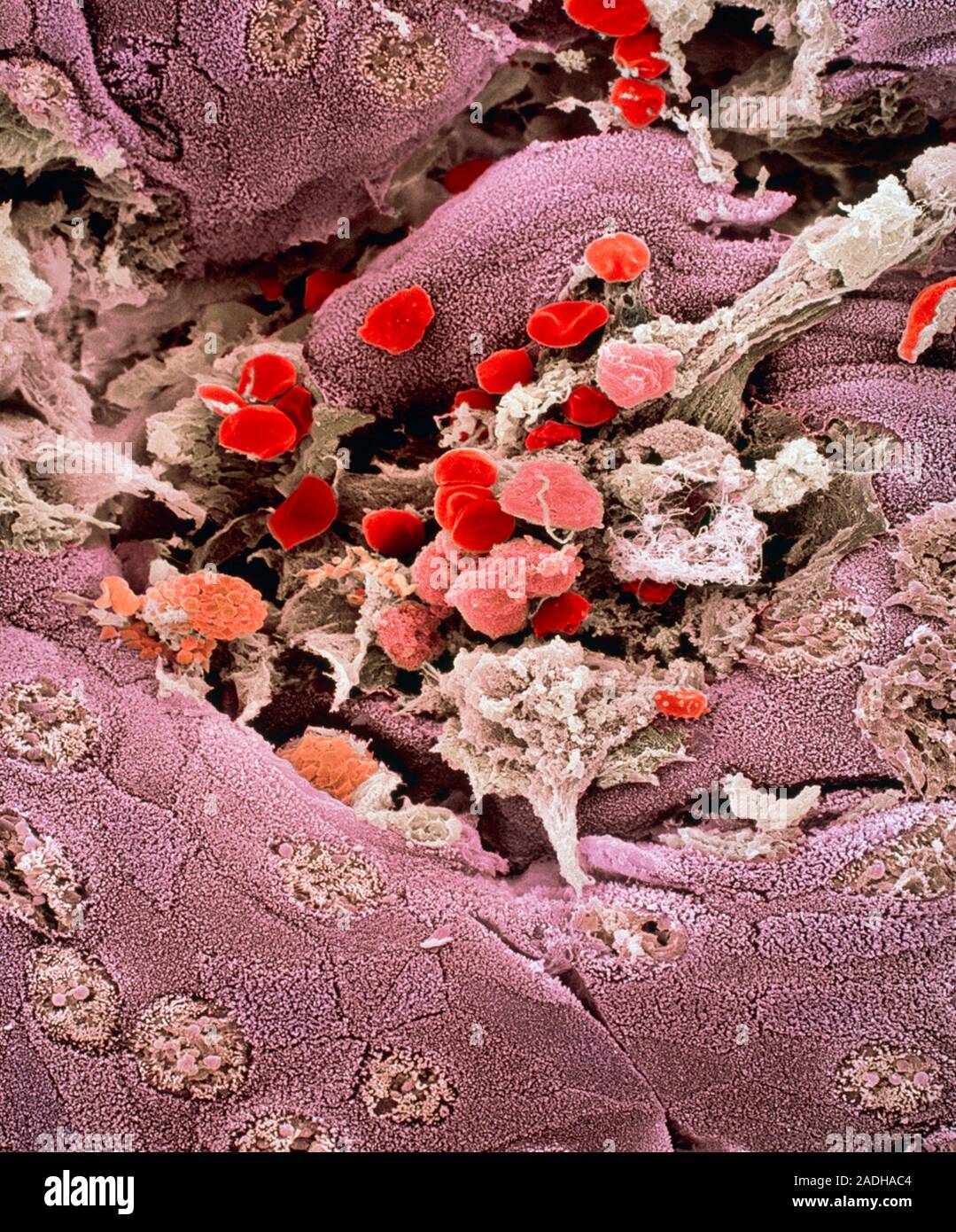 Ulcerative colitis. Coloured scanning electron micrograph (SEM) of ...