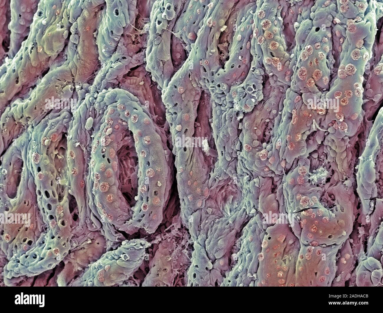Ulcerative colitis. Coloured scanning electron micrograph (SEM) of ...