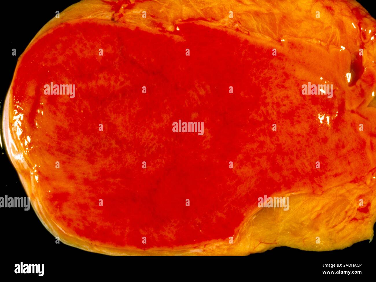 Gallbladder inflammation. Gross clinical specimen of a human ...