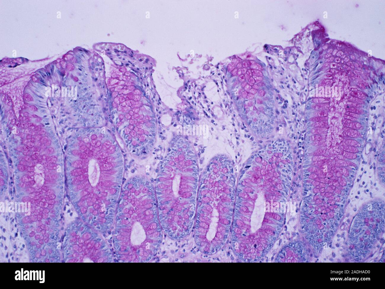 Ulcerative colitis. Light micrograph of a section through the inflamed ...