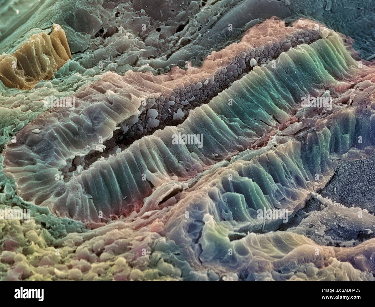 Ulcerative colitis. Coloured scanning electron micrograph (SEM) of ...