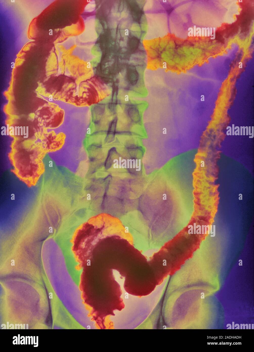 Crohn's disease. Coloured X-ray of the colon (large intestine, red ...