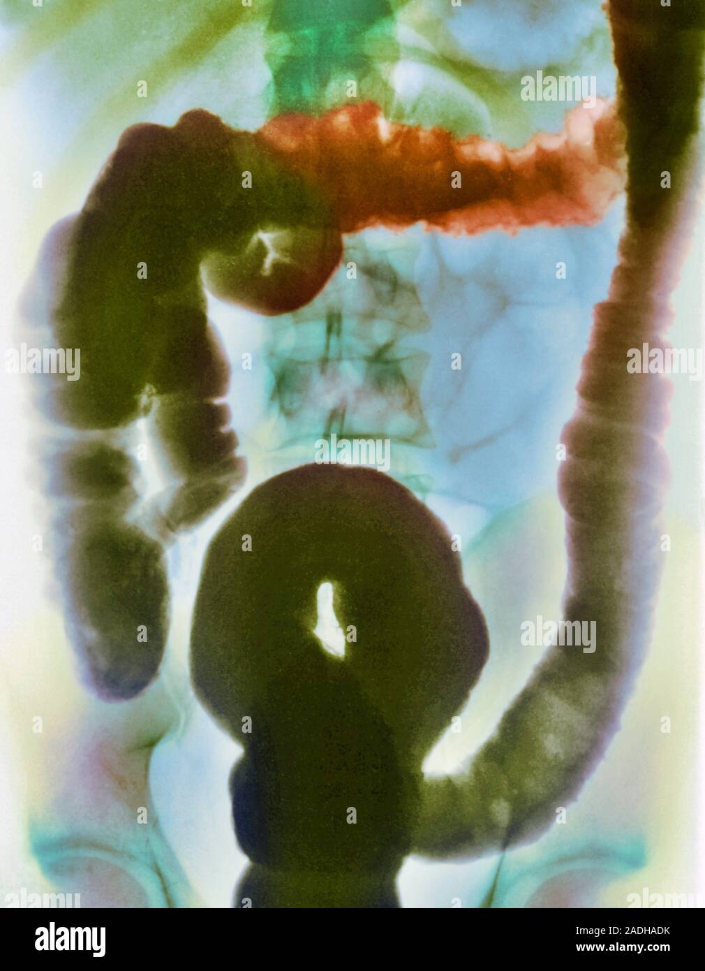 Crohn's disease. Coloured X-ray of the colon (large intestine, brown ...