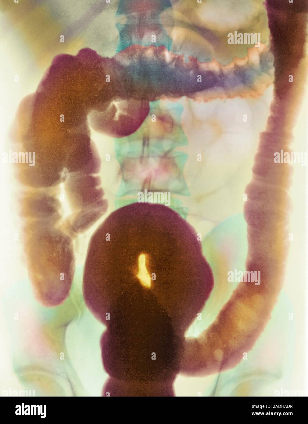 Crohn's disease. Coloured X-ray of the colon (large intestine, brown ...
