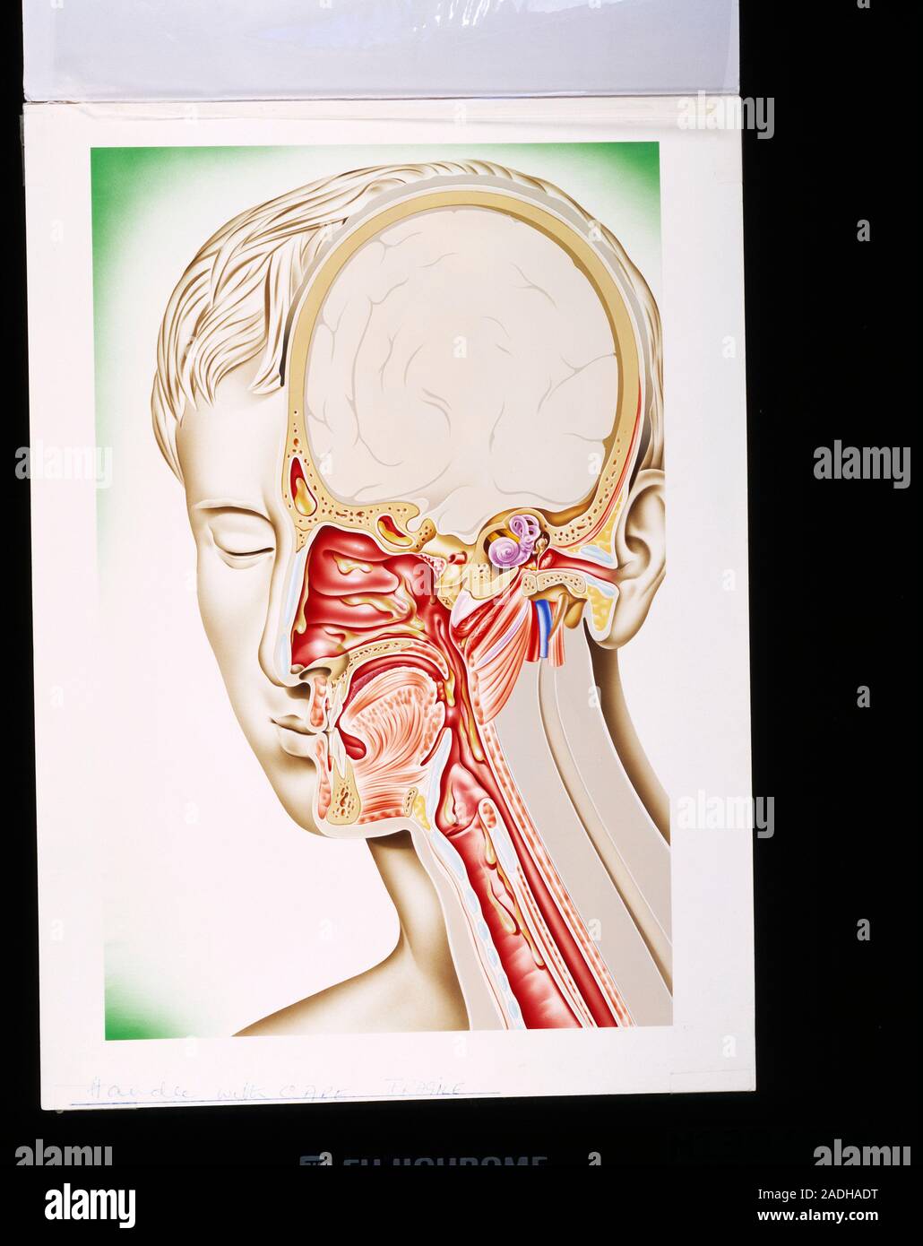 Common cold. Artwork of a sagittal (side view) section through a human ...