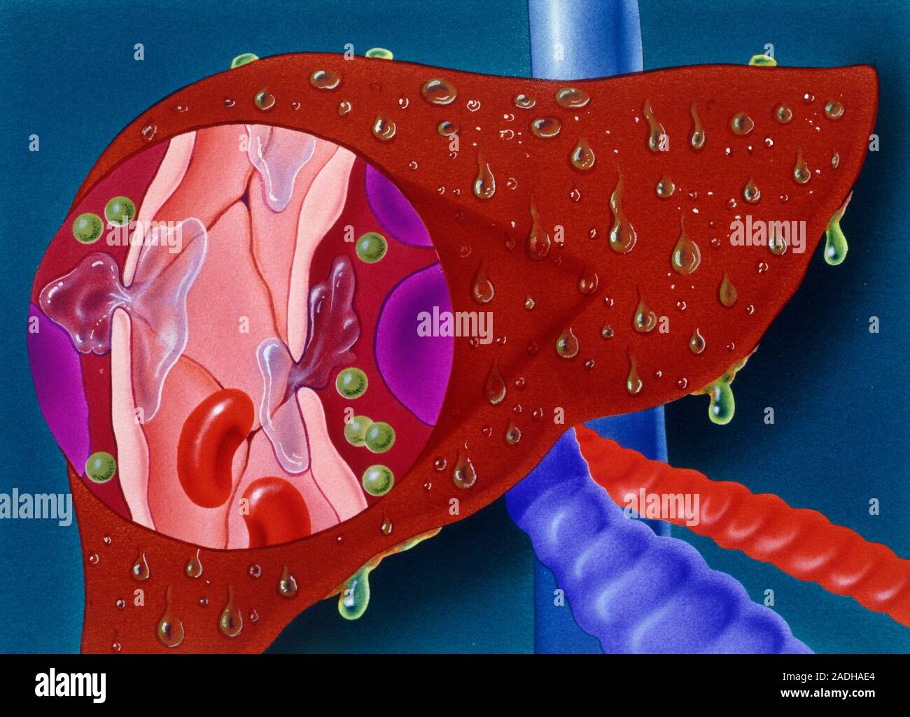 Liver cirrhosis. Image 3 of 4. Artwork of stage three, septal stage, of ...