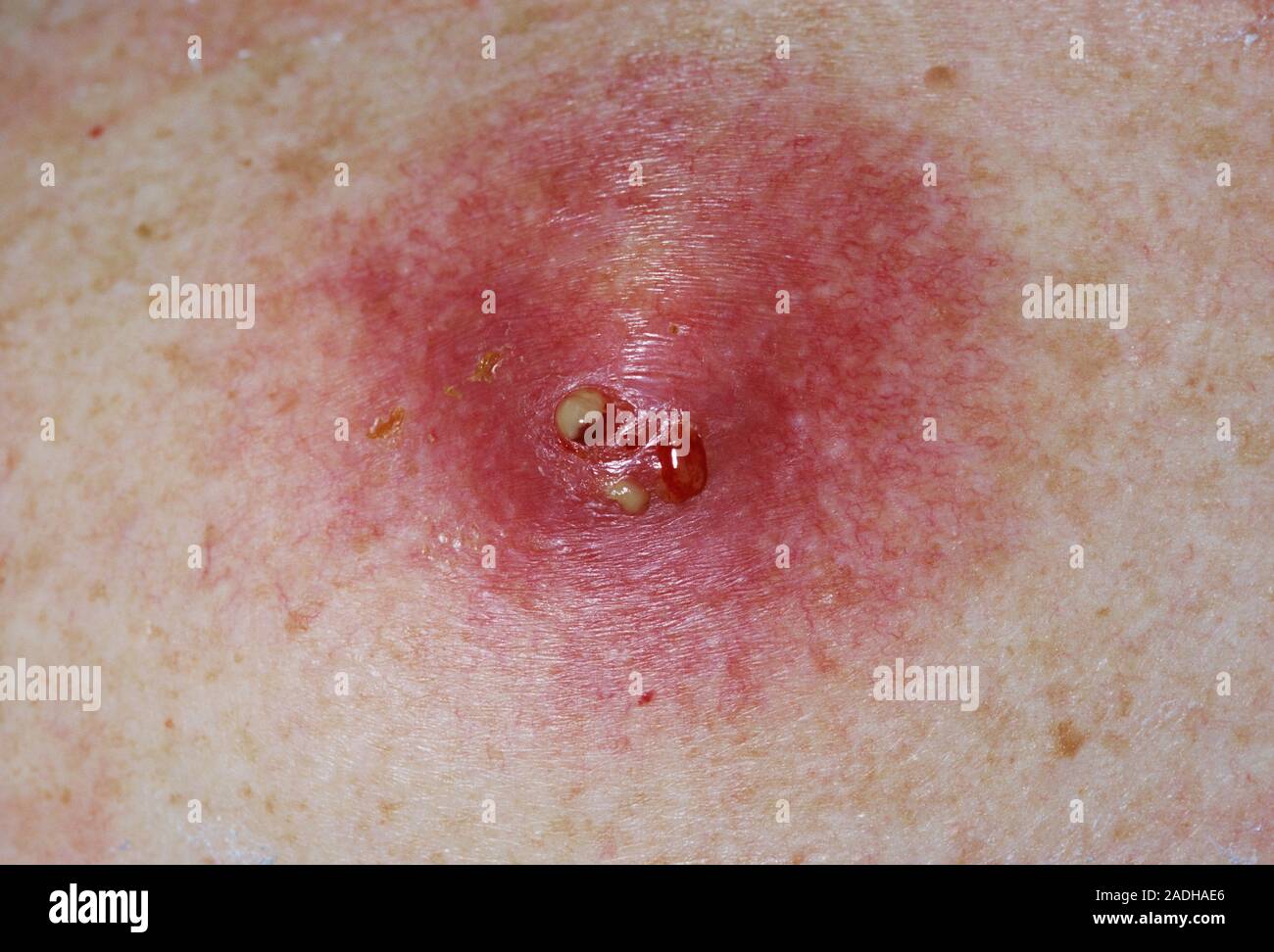 Infected cyst. Close-up of a burst, infected sebaceous cyst on the ...