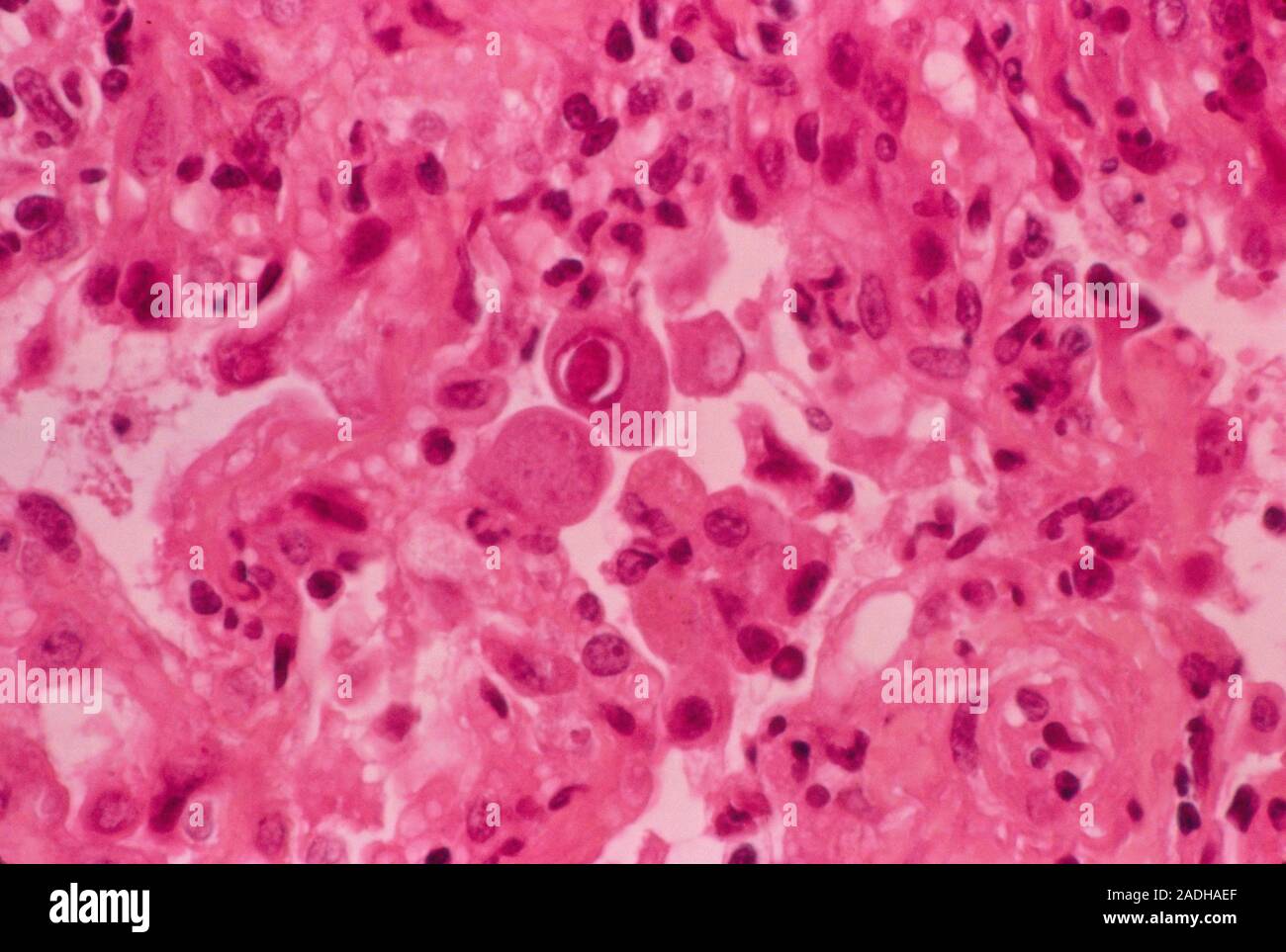 Cytomegalovirus infection. Light micrograph of cells from a patient's ...