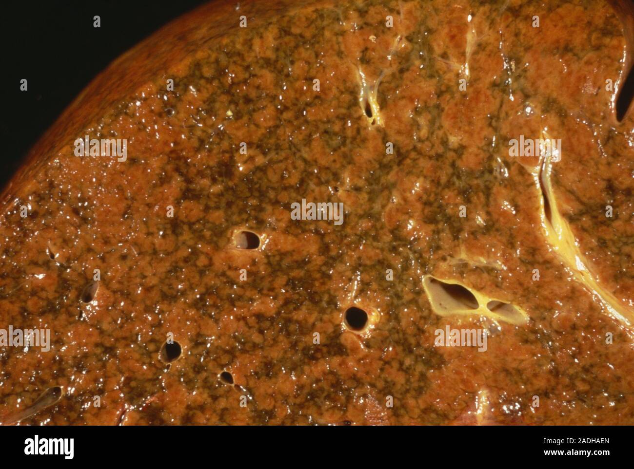 Cirrhosis Of The Liver Gross Specimen Of A Slice Of Tissue From A Liver Affected By Primary