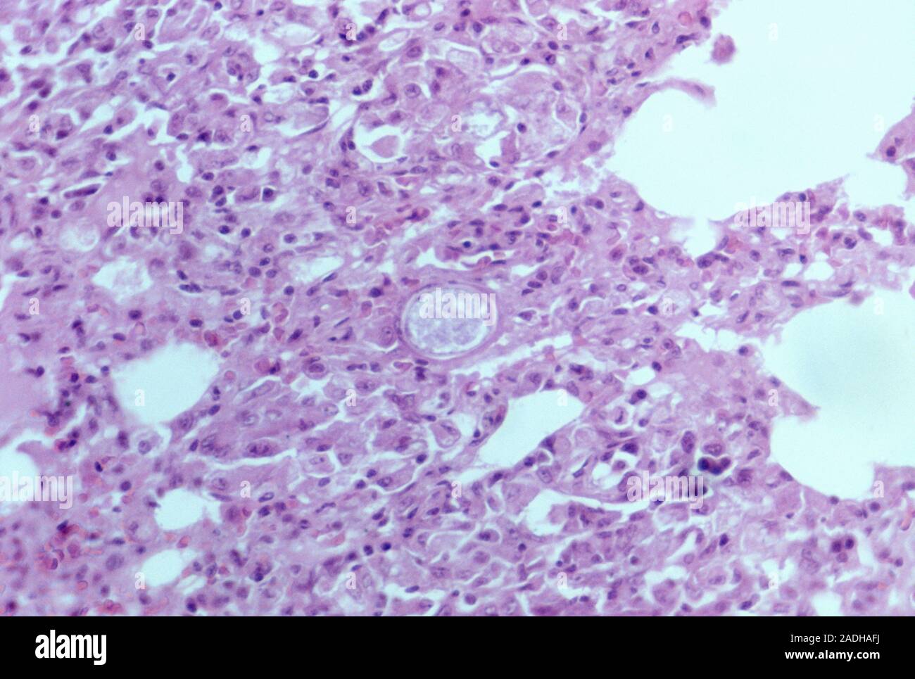 Coccidioidomyocosis. Light micrograph of a section through human lung ...