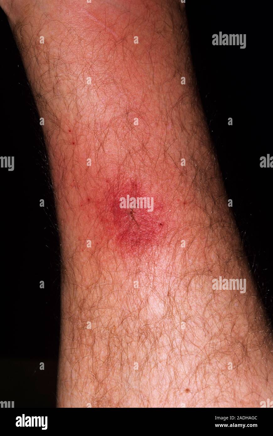 Cellulitis On A 47 Year Old Womans Leg One Week After An Insect Bite Cellulitis Is A
