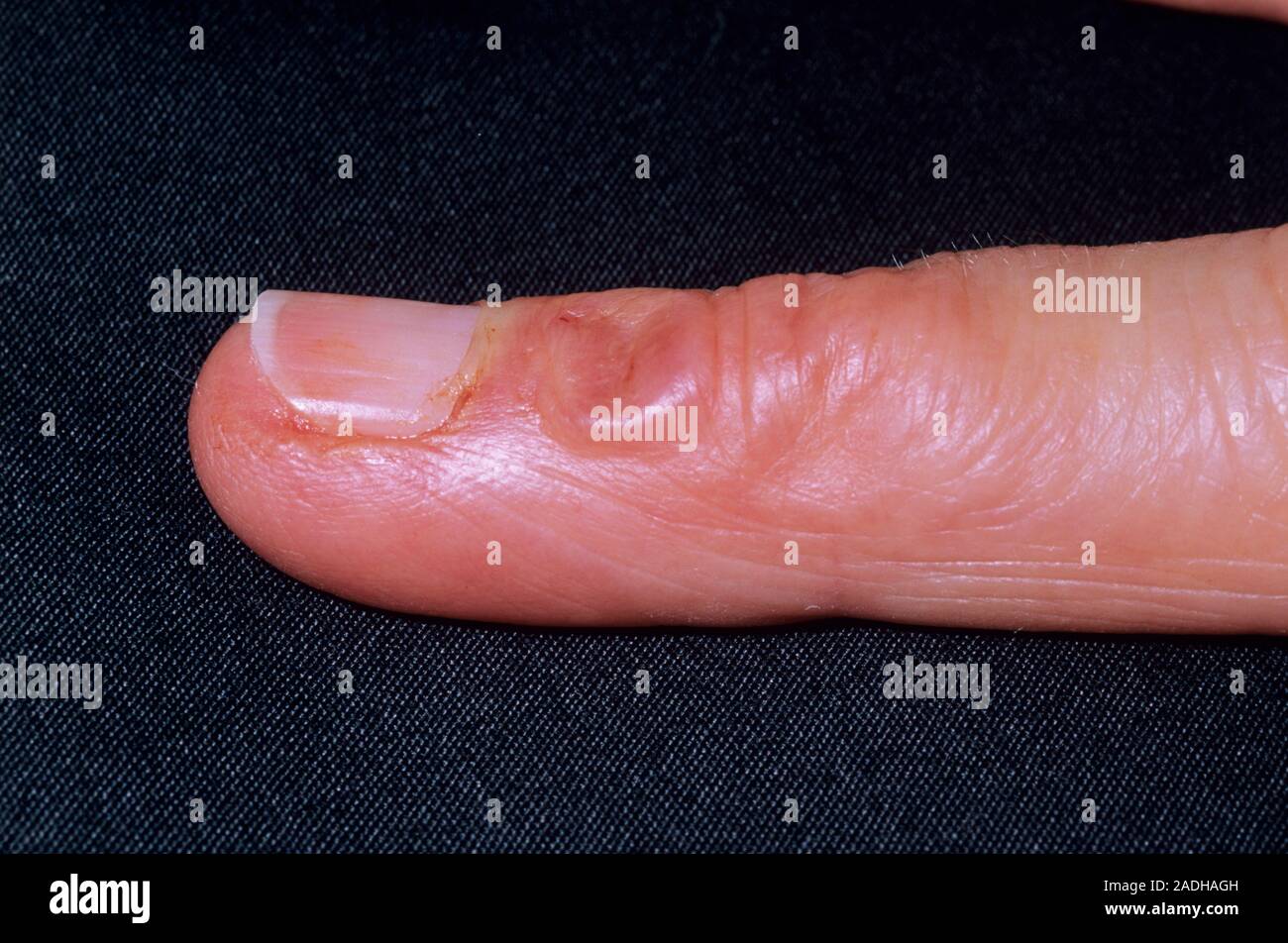 Synovial cyst. Image 2 of 2. Drained synovial cyst on the finger of a ...