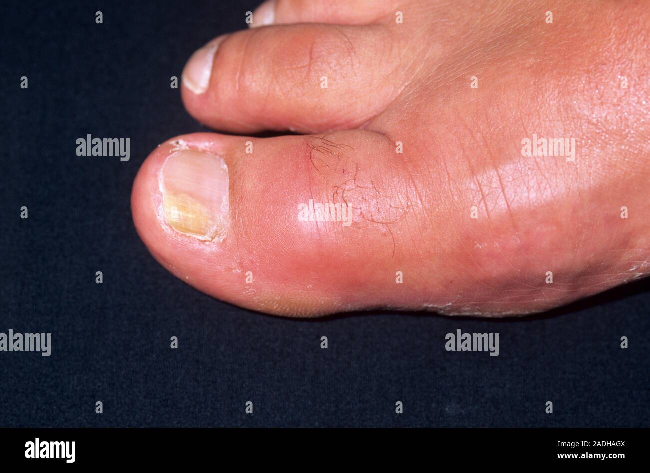 Cellulitis on a 54-year-old man's big toe. Cellulitis is a bacterial ...