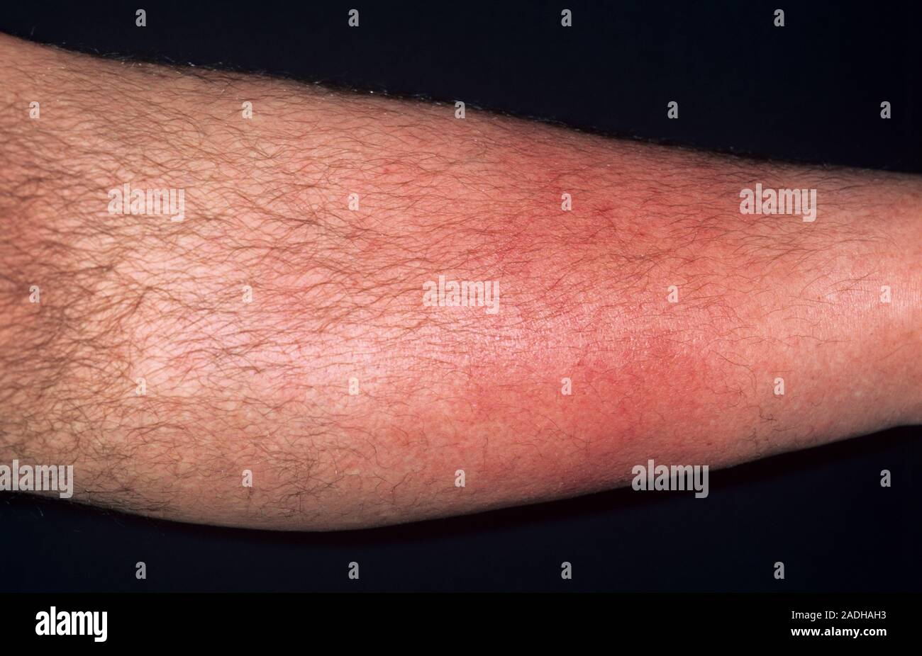 Recurrent cellulitis on a 51-year-old man's lower leg. Cellulitis is a ...