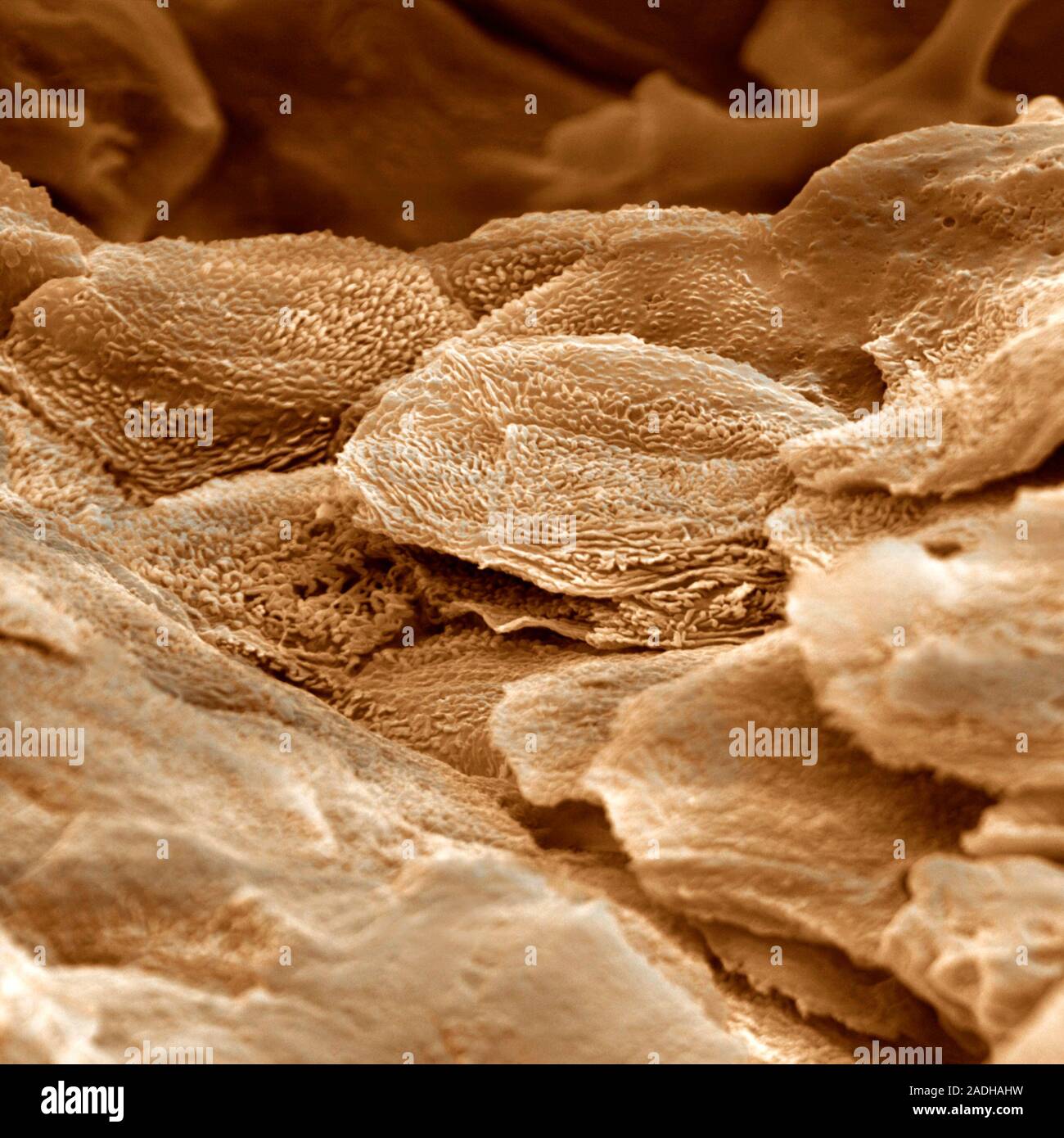Hard skin. Coloured scanning electron micrograph (SEM) of hard skin on ...